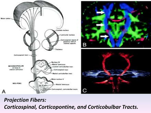Presentation1.pptx, diffusion tensor imaging of white matter tract in ...