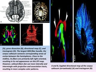 Presentation1.pptx, diffusion tensor imaging of white matter tract in ...