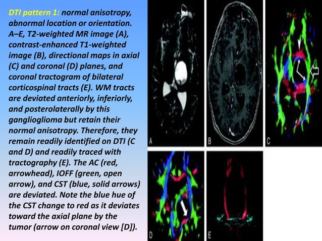 Presentation1.pptx, diffusion tensor imaging of white matter tract in cerebral neoplasm. | PPTX ...