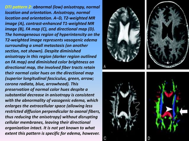 Presentation1.pptx, diffusion tensor imaging of white matter tract in cerebral neoplasm. | PPTX ...