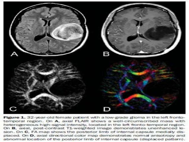 Presentation1.pptx, diffusion tensor imaging of white matter tract in cerebral neoplasm. | PPTX ...
