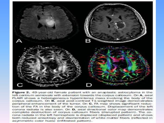 Presentation1.pptx, diffusion tensor imaging of white matter tract in cerebral neoplasm. | PPTX ...