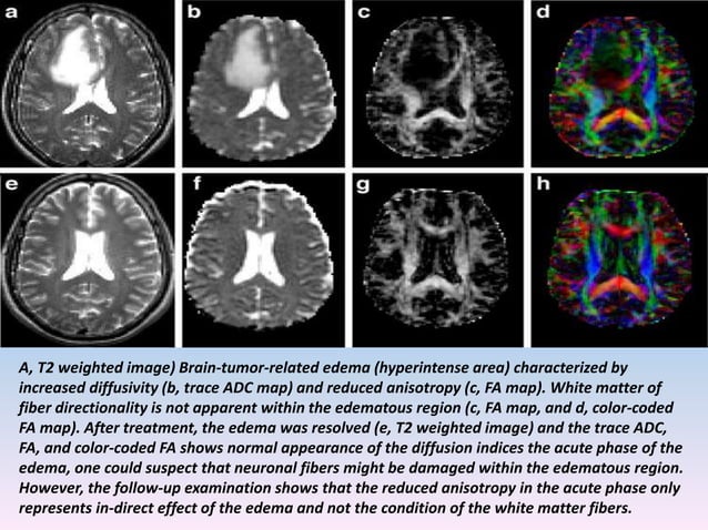 Presentation1.pptx, diffusion tensor imaging of white matter tract in cerebral neoplasm. | PPTX ...