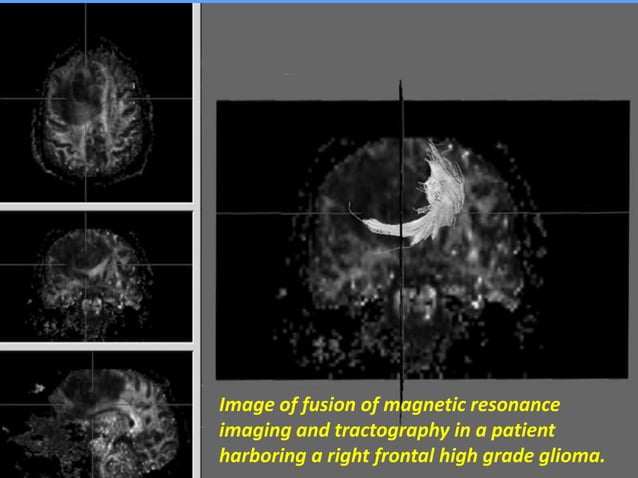 Presentation1.pptx, diffusion tensor imaging of white matter tract in cerebral neoplasm. | PPTX ...