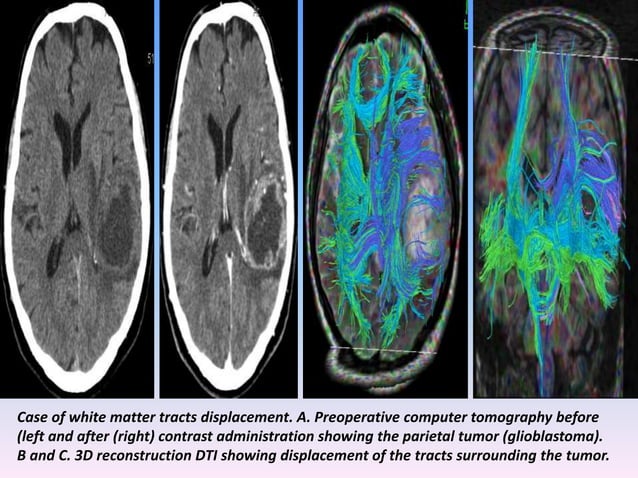 Presentation1.pptx, diffusion tensor imaging of white matter tract in cerebral neoplasm. | PPTX ...