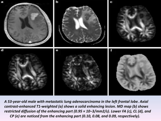 Presentation1.pptx, diffusion tensor imaging of white matter tract in cerebral neoplasm. | PPTX ...