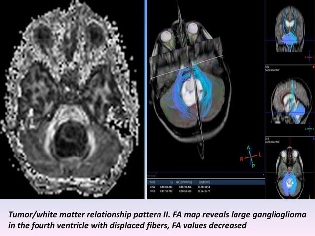Presentation1.pptx, diffusion tensor imaging of white matter tract in cerebral neoplasm. | PPTX ...