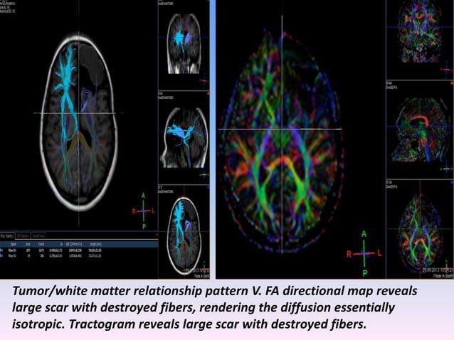 Presentation1.pptx, diffusion tensor imaging of white matter tract in cerebral neoplasm. | PPTX ...