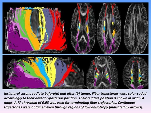 Presentation1.pptx, diffusion tensor imaging of white matter tract in cerebral neoplasm. | PPTX ...