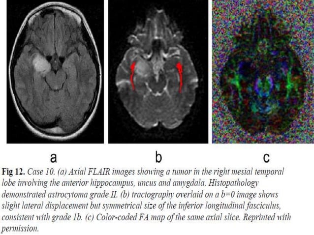 Presentation1.pptx, diffusion tensor imaging of white matter tract in ...