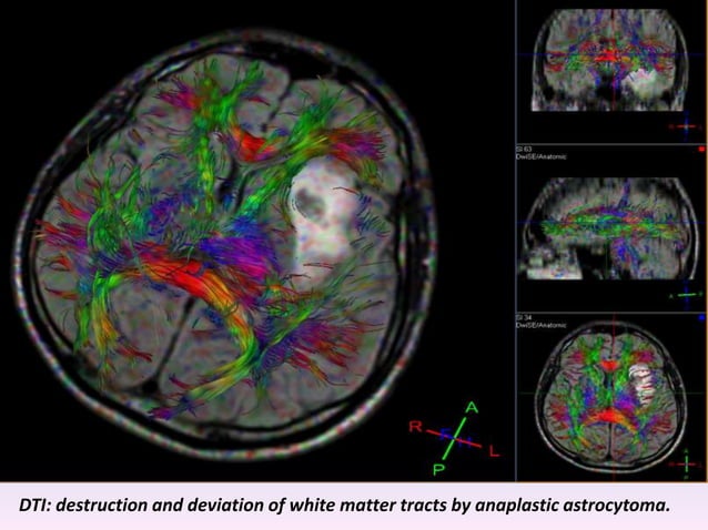 Presentation1.pptx, diffusion tensor imaging of white matter tract in ...