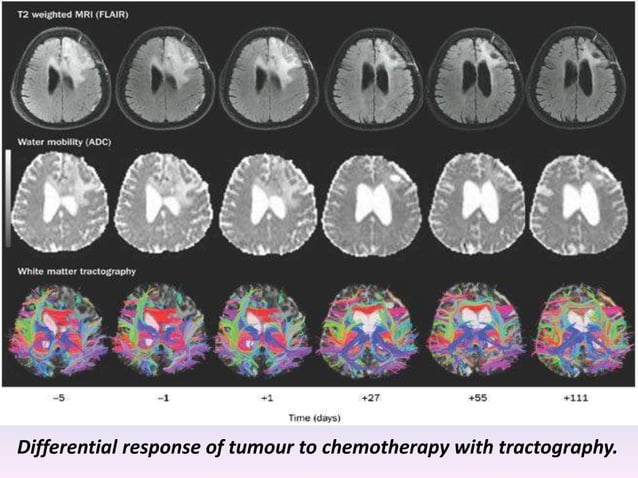 Presentation1.pptx, diffusion tensor imaging of white matter tract in ...