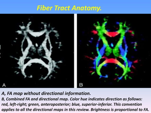 Presentation1.pptx, diffusion tensor imaging of white matter tract in ...