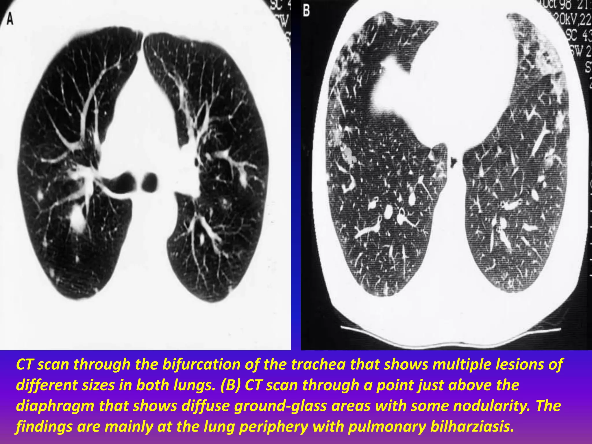 Presentation1.pptx, radiological imaging of bilaharziasis. | PPTX