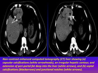 Presentation1.pptx, radiological imaging of bilaharziasis. | PPTX