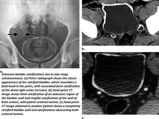 Presentation1.pptx, radiological imaging of bilaharziasis. | PPTX
