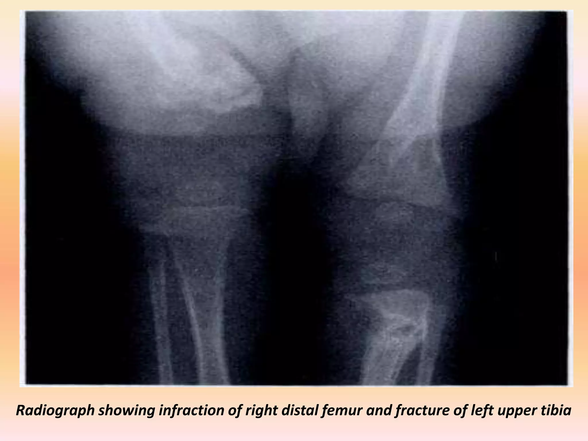 Presentation1.pptx, radiological imaging of syphilis. | PPTX ...