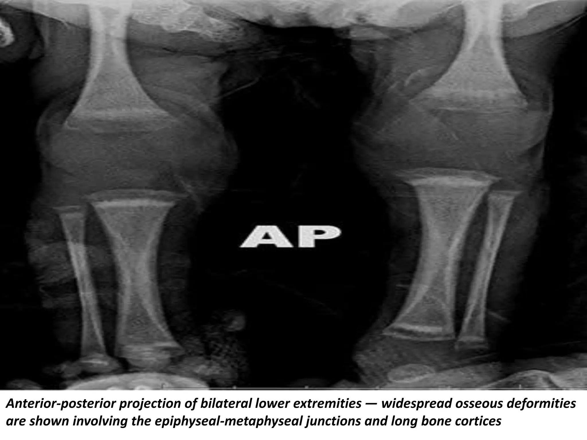 Presentation1.pptx, radiological imaging of syphilis. | PPTX ...