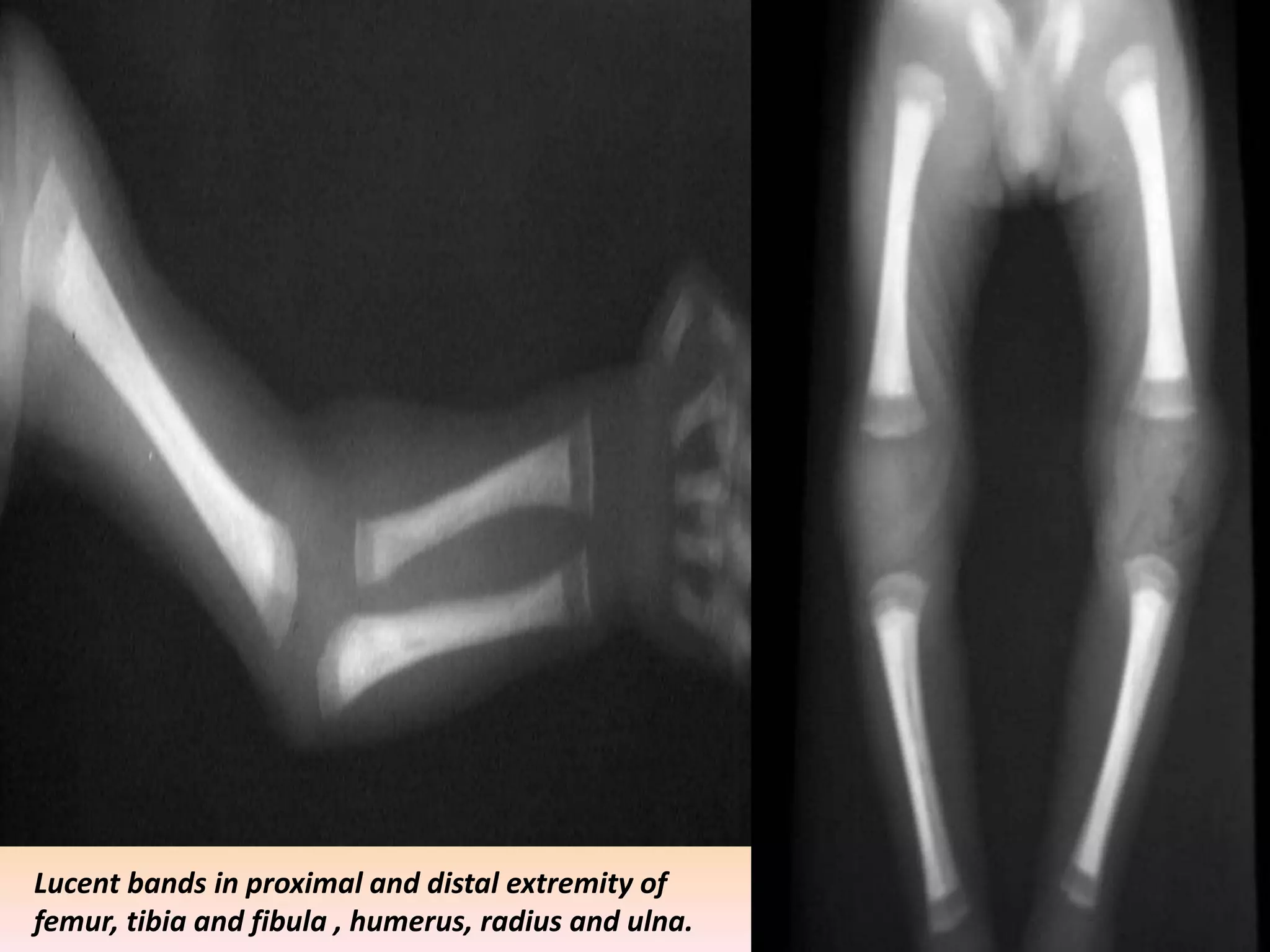 Presentation1.pptx, radiological imaging of syphilis. | PPTX ...