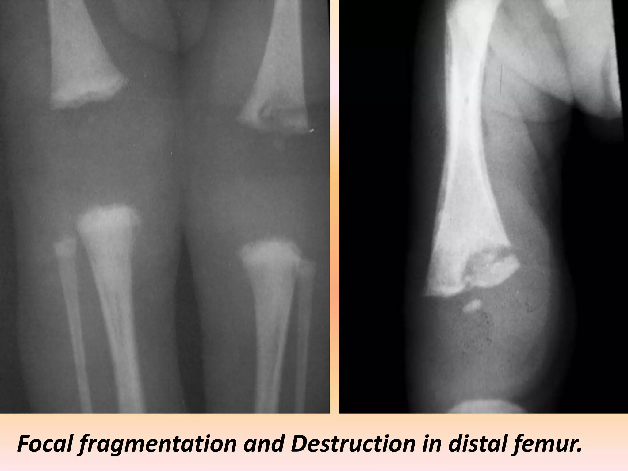 Presentation1.pptx, radiological imaging of syphilis. | PPTX ...