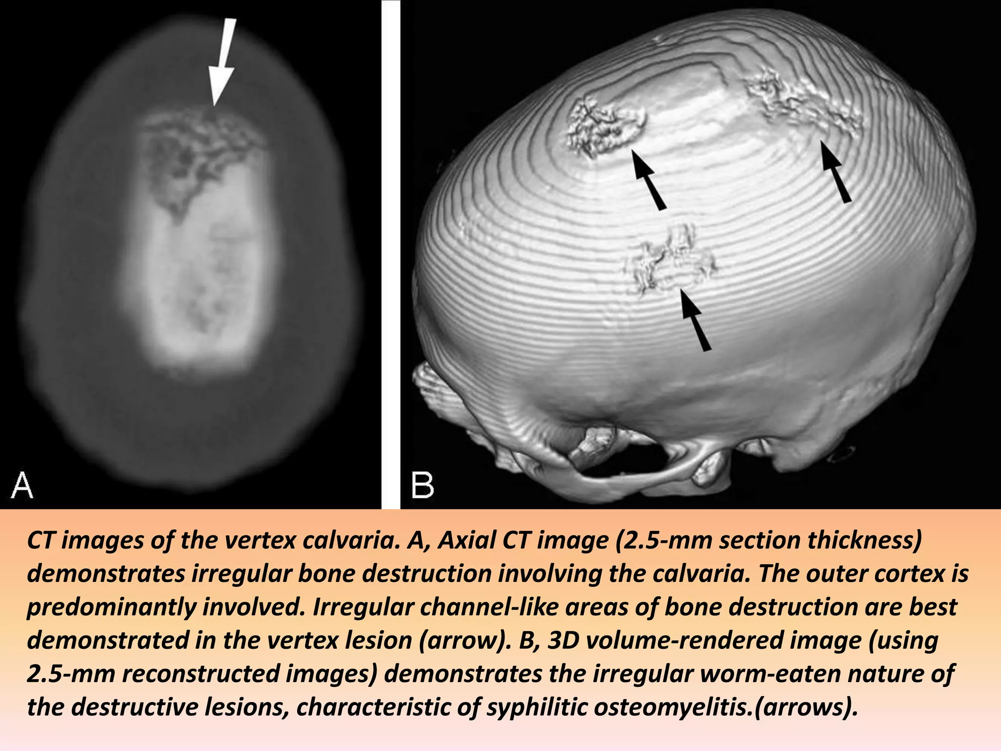Presentation1.pptx, radiological imaging of syphilis. | PPTX ...