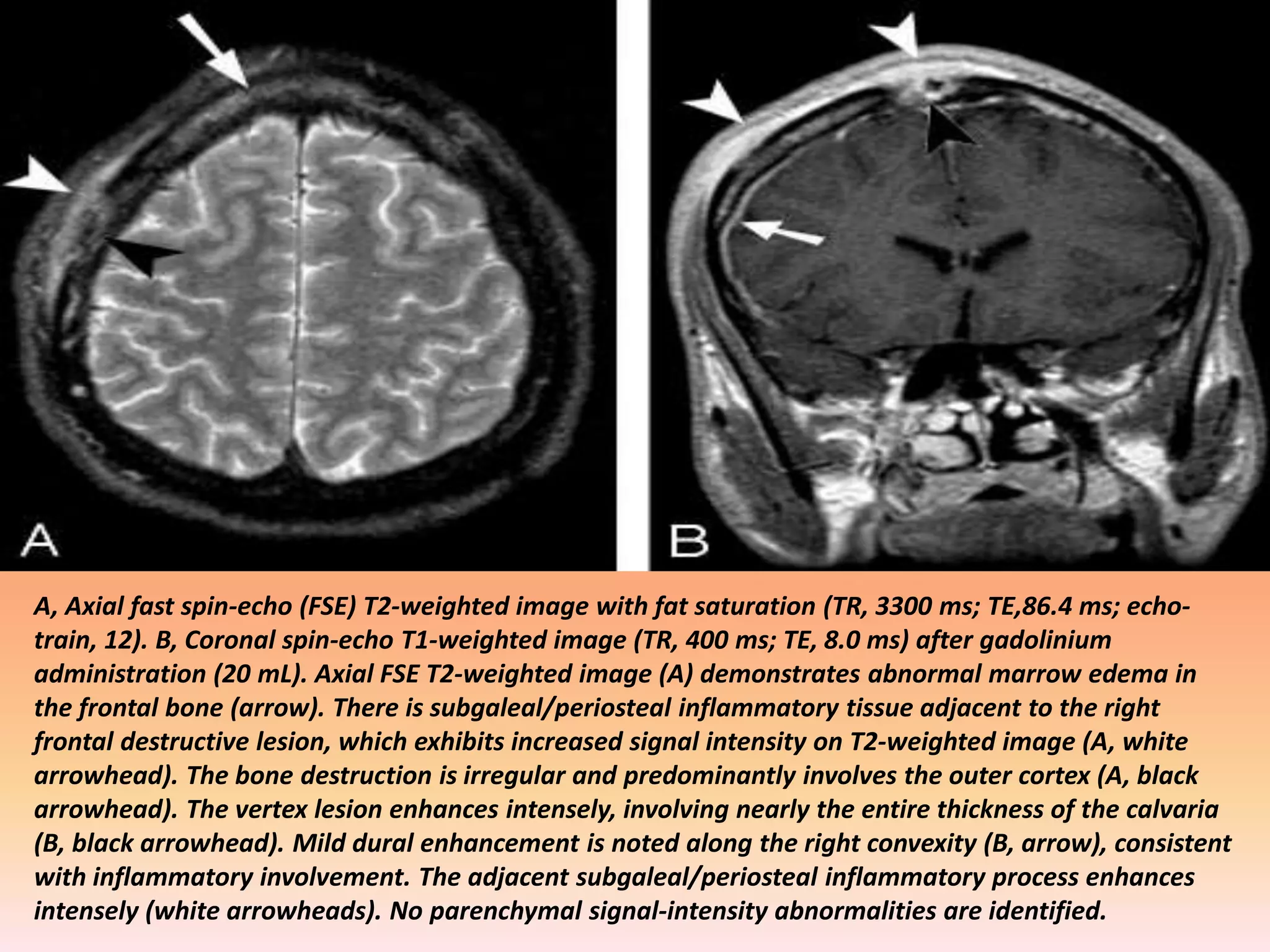 Presentation1.pptx, radiological imaging of syphilis. | PPTX ...