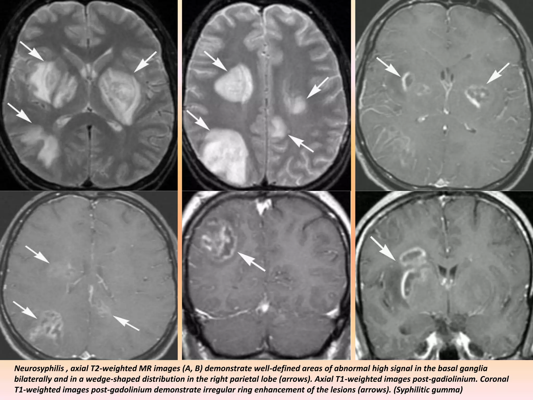 Presentation1.pptx, radiological imaging of syphilis. | PPT