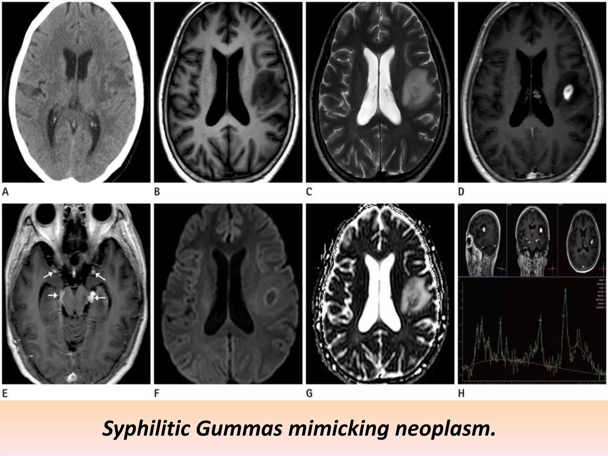 Presentation1.pptx, radiological imaging of syphilis. | PPTX ...