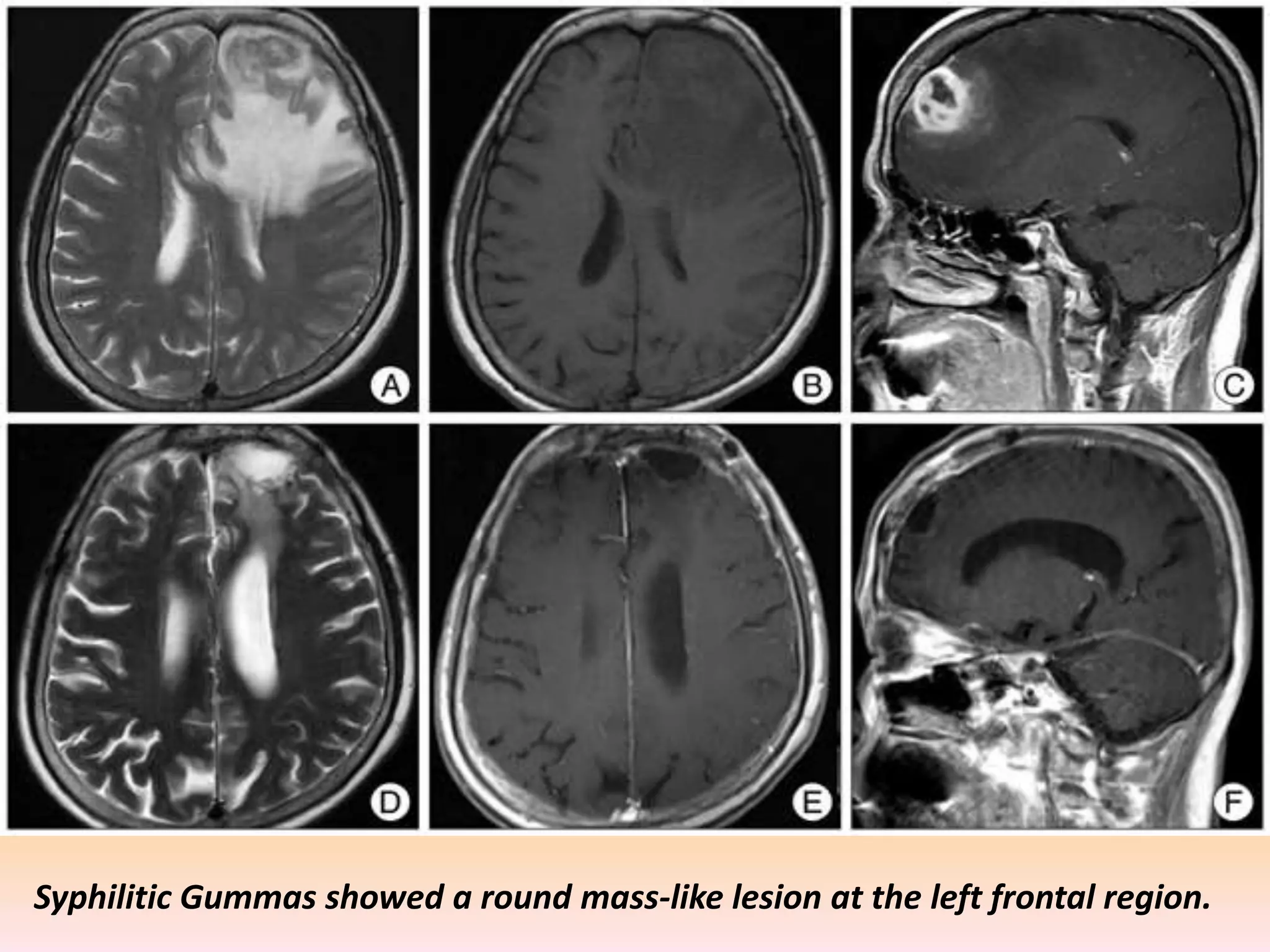 Presentation1.pptx, radiological imaging of syphilis. | PPTX ...
