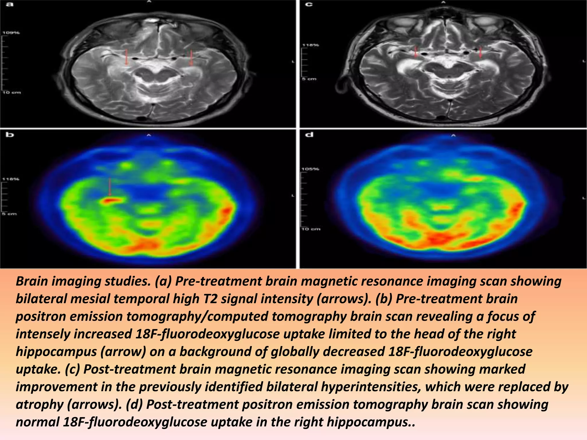 Presentation1.pptx, radiological imaging of syphilis. | PPTX ...