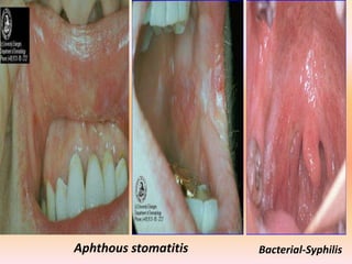 Presentation1.pptx, radiological imaging of syphilis. | PPTX