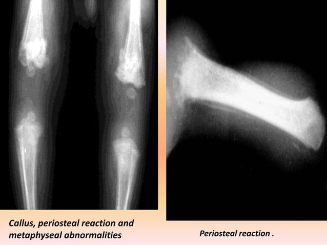 Presentation1.pptx, radiological imaging of syphilis. | PPT