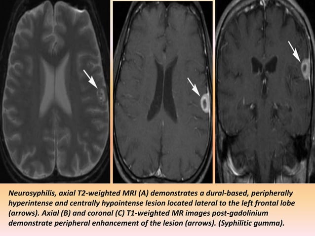 Presentation1.pptx, radiological imaging of syphilis. | PPTX ...