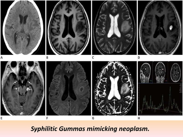 Presentation1.pptx, radiological imaging of syphilis. | PPT