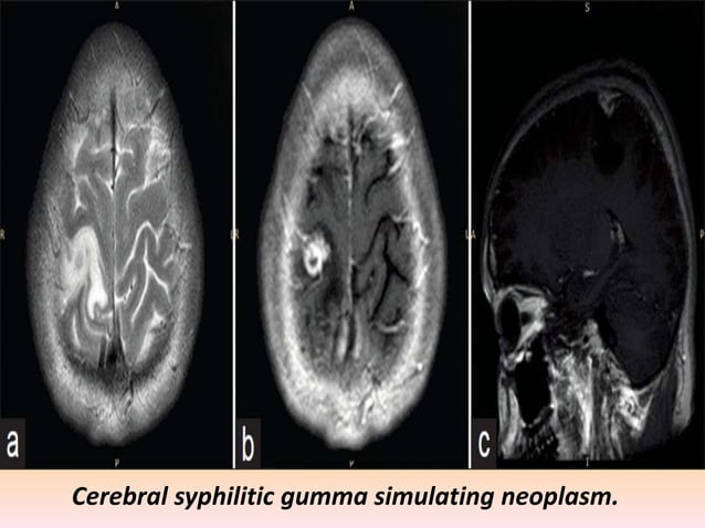 Presentation1.pptx, radiological imaging of syphilis. | PPTX ...
