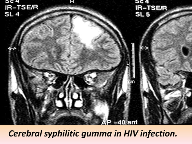 Presentation1.pptx, radiological imaging of syphilis. | PPTX ...