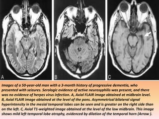 Presentation1.pptx, radiological imaging of syphilis. | PPTX