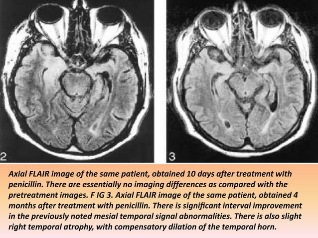 Presentation1.pptx, radiological imaging of syphilis. | PPTX ...