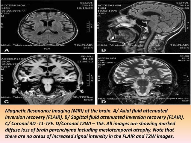 Presentation1.pptx, radiological imaging of syphilis. | PPTX ...