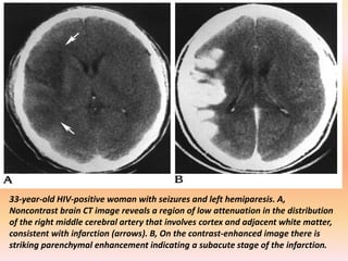 Presentation1.pptx, radiological imaging of syphilis. | PPTX