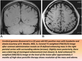 Presentation1.pptx, radiological imaging of syphilis. | PPTX