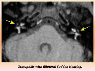 Presentation1.pptx, radiological imaging of syphilis. | PPTX