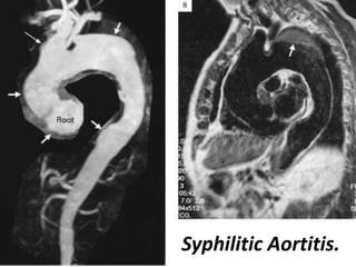 Presentation1.pptx, radiological imaging of syphilis. | PPTX