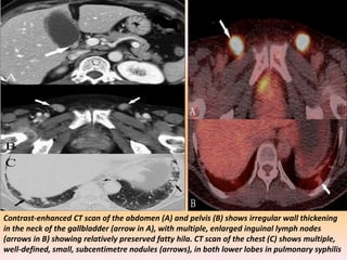 Presentation1.pptx, radiological imaging of syphilis. | PPTX