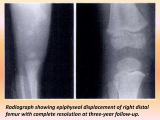 Congenital Syphilis Xray
