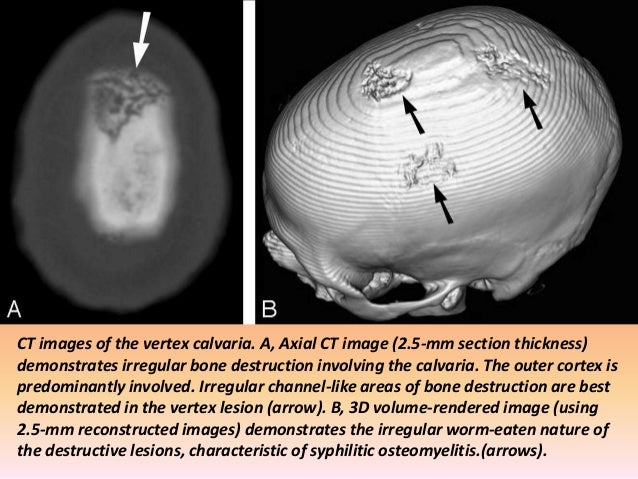 Presentation1.pptx, radiological imaging of syphilis.