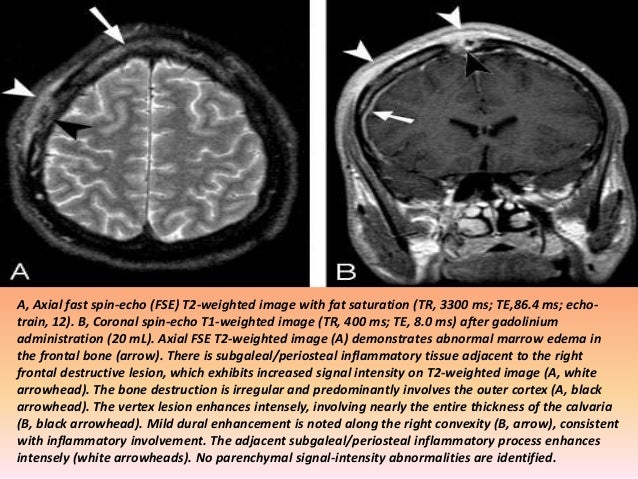 Presentation1.pptx, radiological imaging of syphilis.