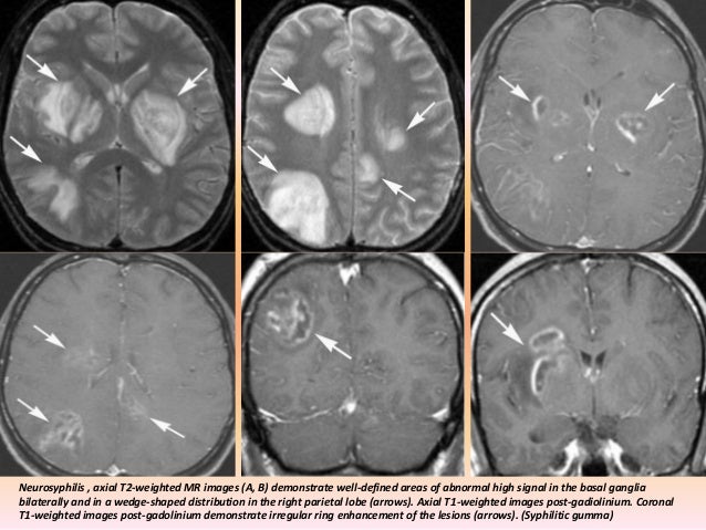 Presentation1.pptx, radiological imaging of syphilis.