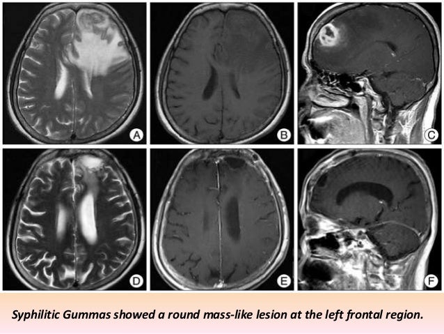 Presentation1.pptx, radiological imaging of syphilis.