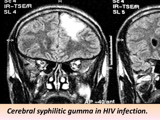 Presentation1.pptx, radiological imaging of syphilis.